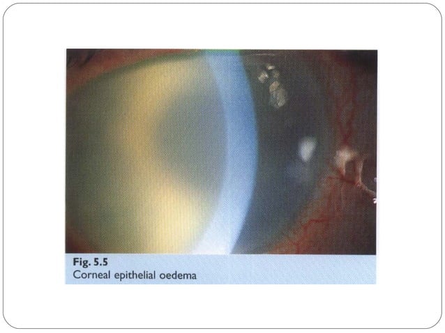 Cornea | PPT | Eye and Vision Conditions | Diseases and Conditions