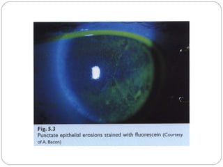 Punctate Epithelial Erosion