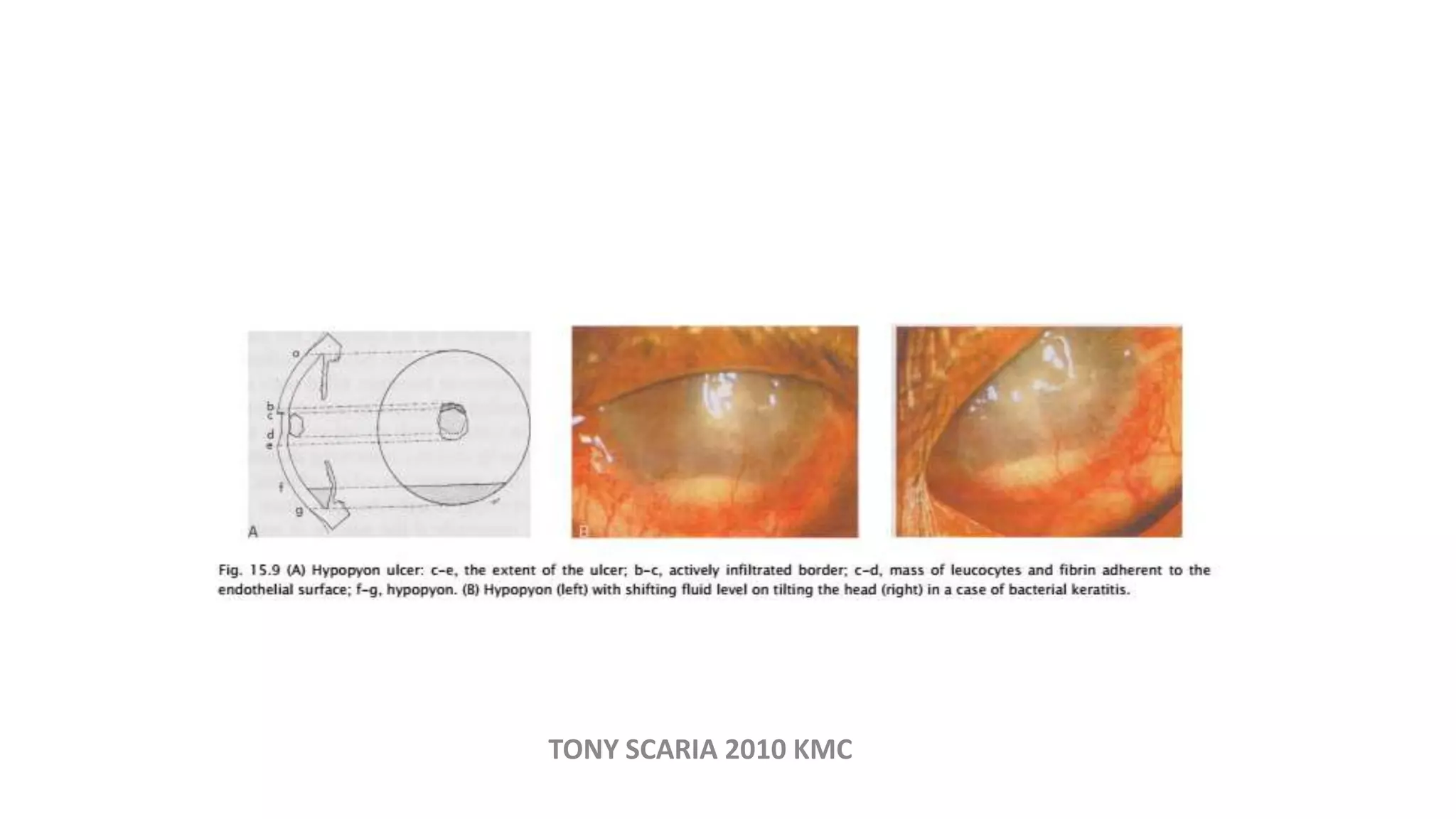 Cornea REVISION NOTES | PPT