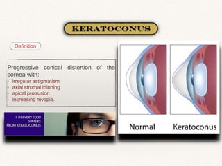 Cornea.ppt