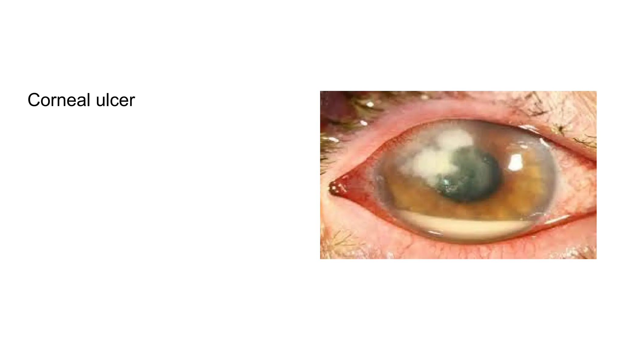 Cornea - Anatomy and Pathology - Pathology - Optometry | PPTX