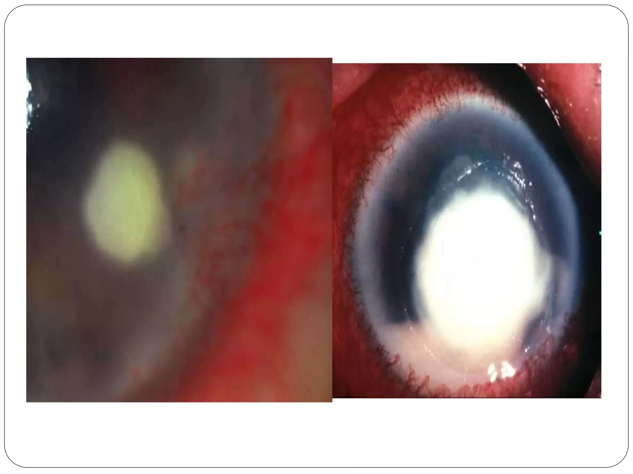 Cornea-Sclera.ppt | Free Download