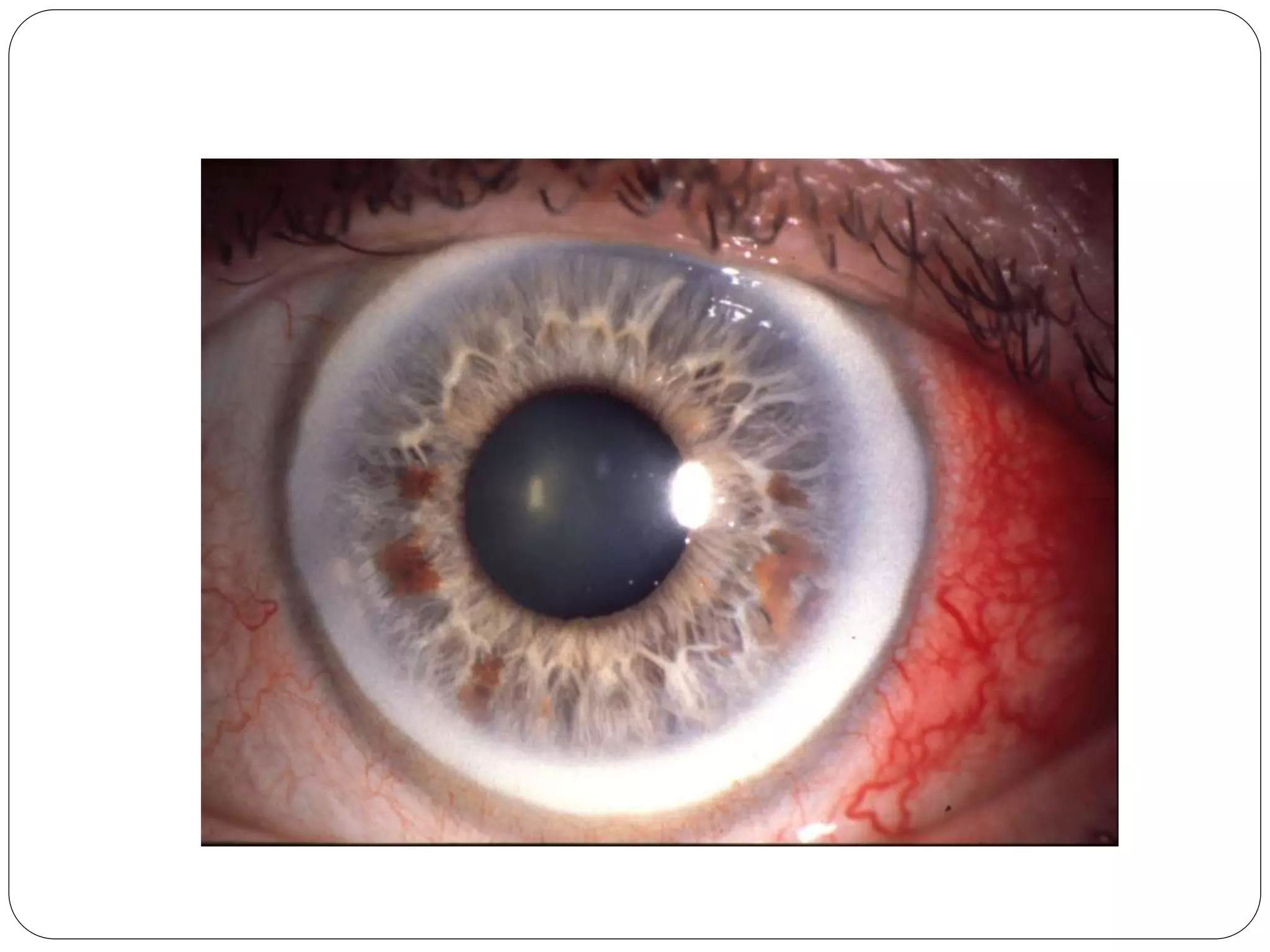 Cornea-Sclera.ppt