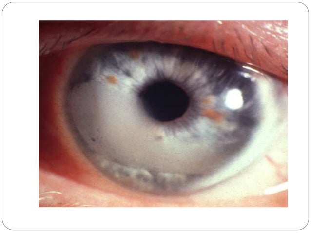 Cornea-Sclera.ppt