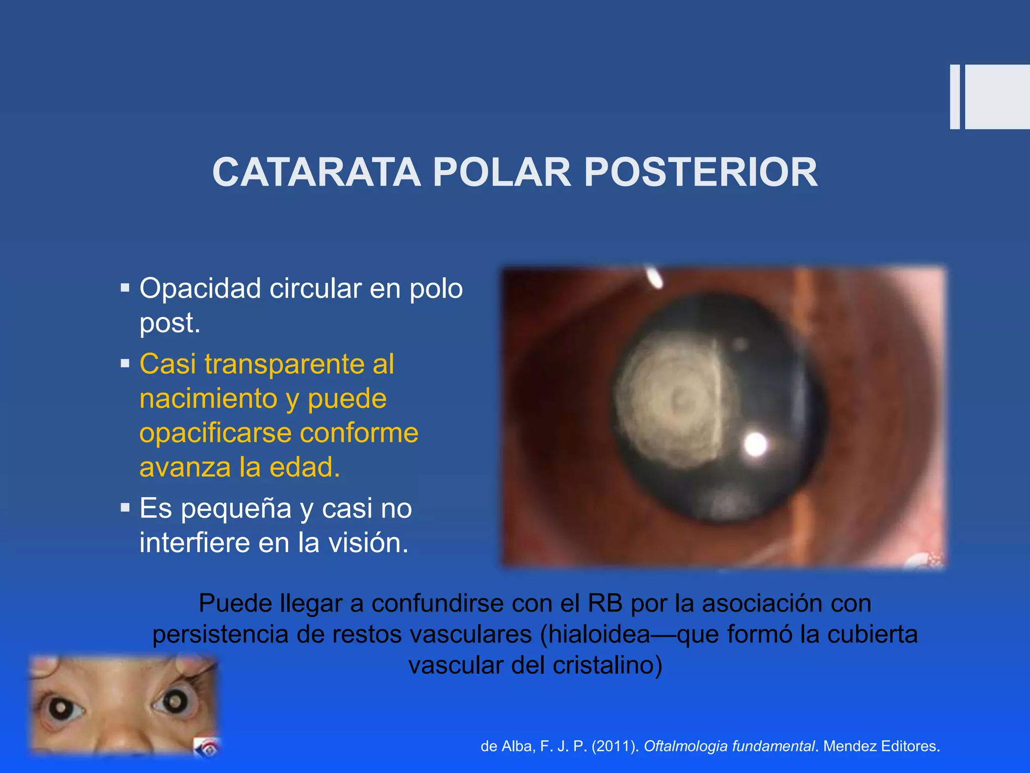 CATARATAS. AnatomÍa de Cornea y Cristalino. | PPTX
