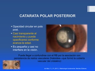 CATARATAS. AnatomÍa de Cornea y Cristalino. | PPTX