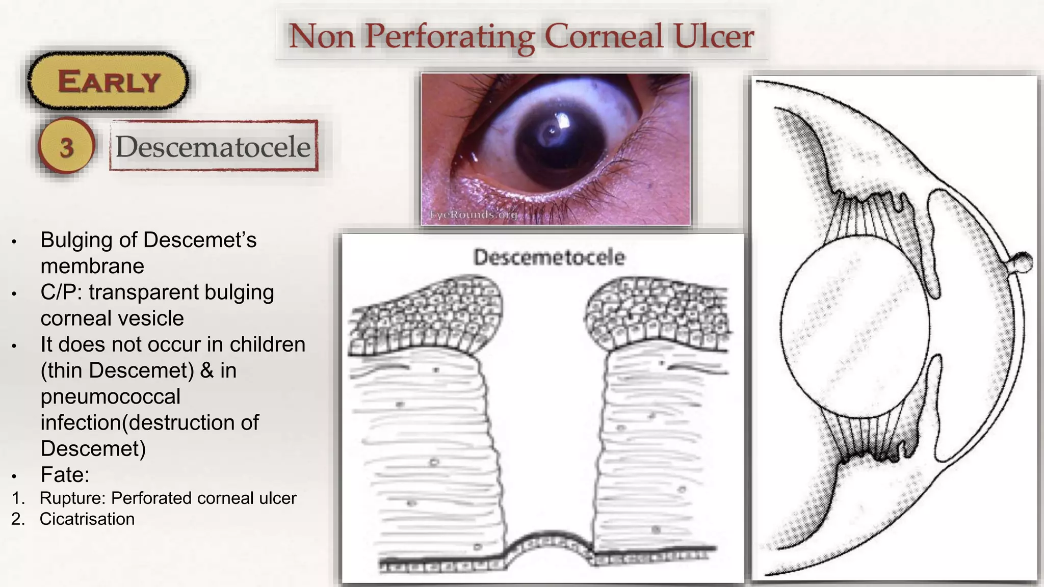 Cornea 1 | PPTX