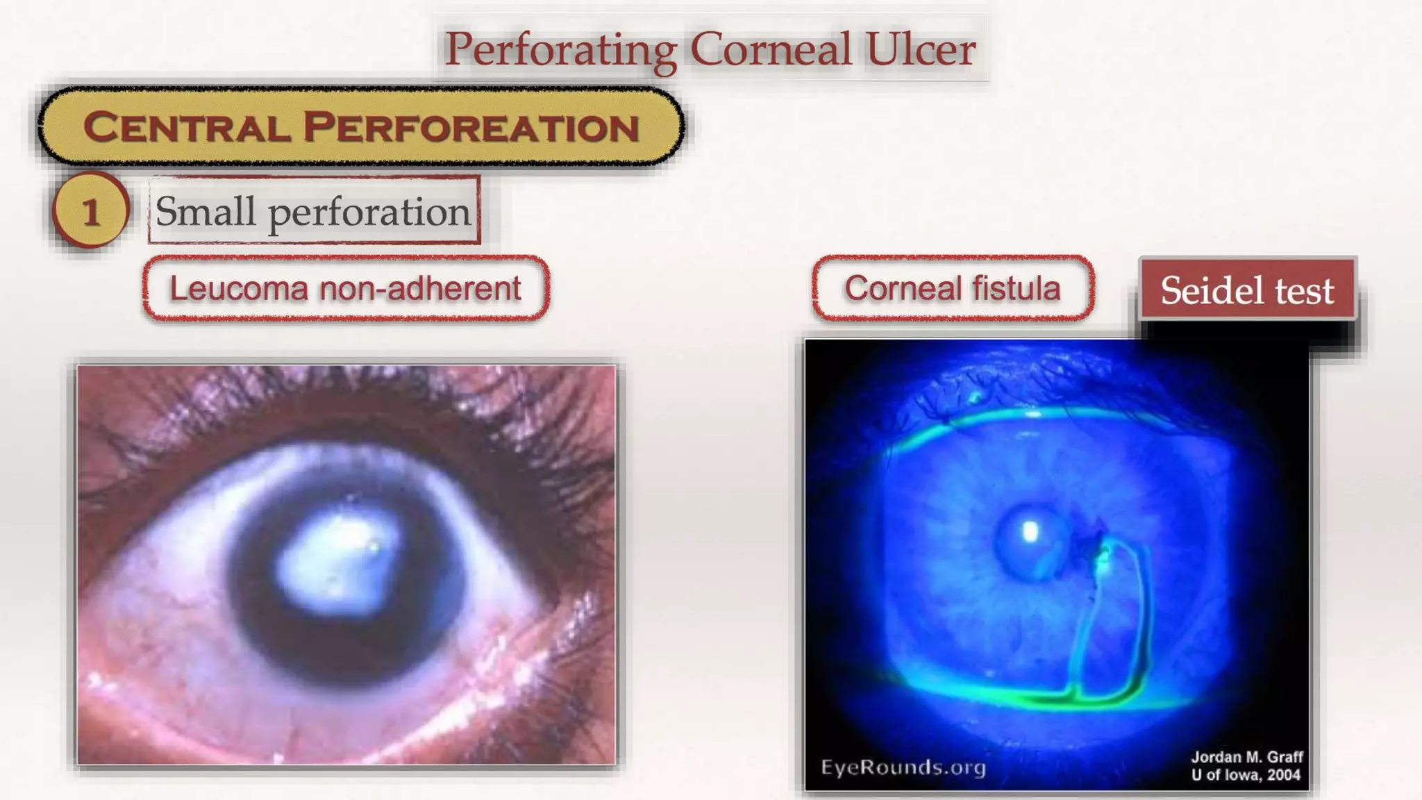 Cornea 1 | PPTX