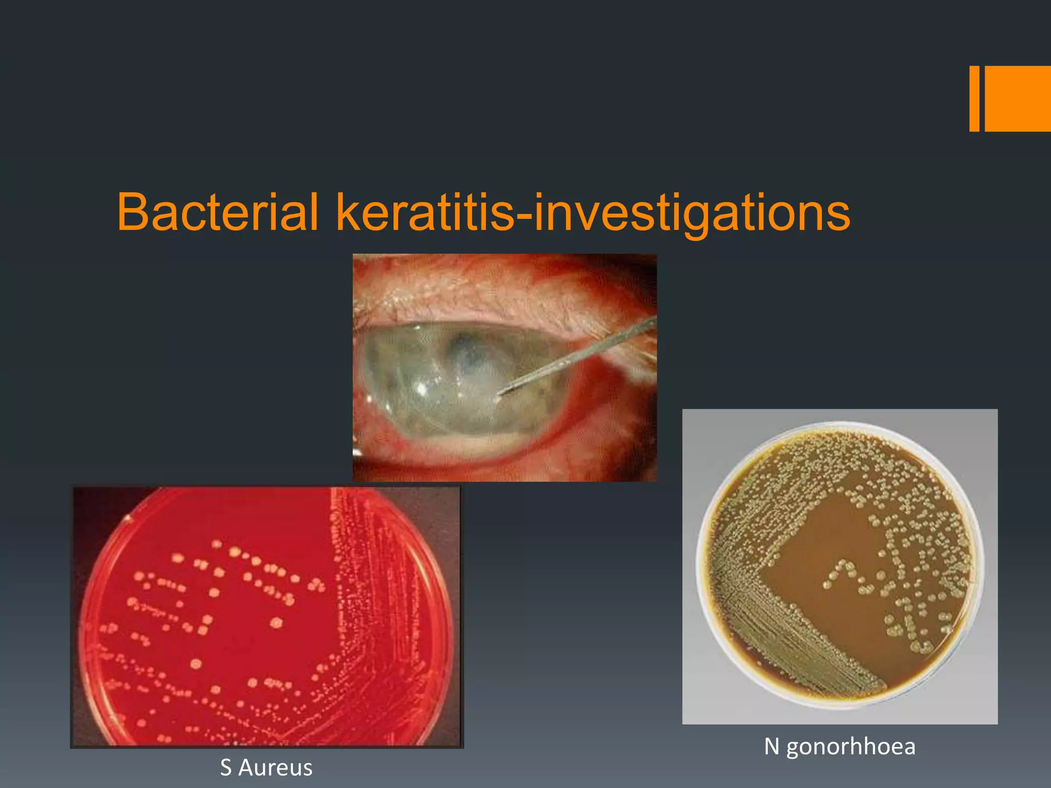 Cornea: Bacterial Keratitis | PPT