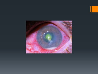 Cornea: Bacterial Keratitis | PPTX