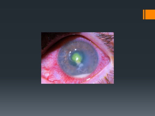 Cornea: Bacterial Keratitis | PPT