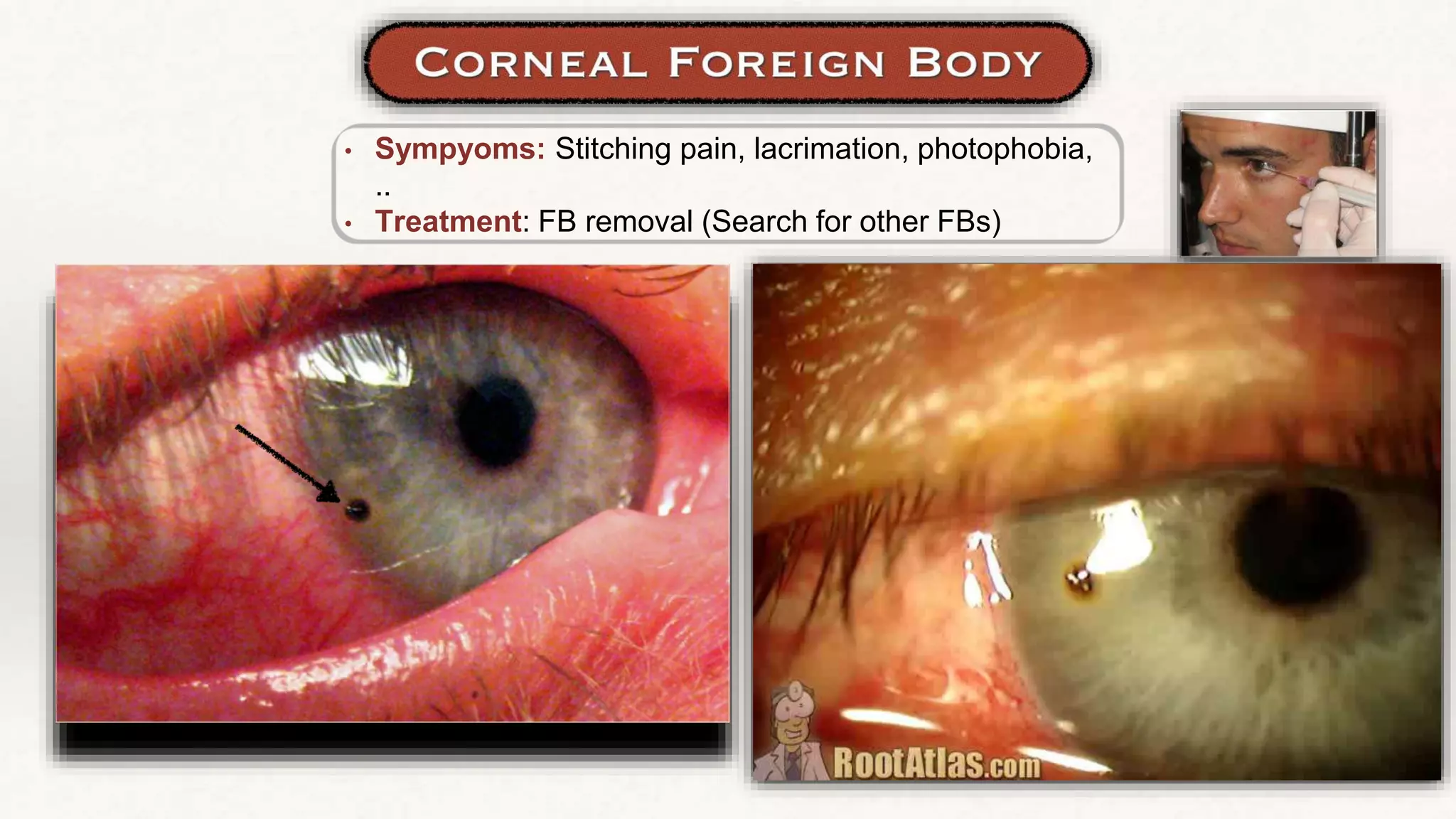 Cornea 2 | PPTX