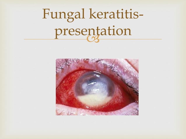 Cornea : Fungal Keratitis | PPT