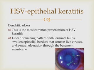 Cornea : Fungal Keratitis | PPT