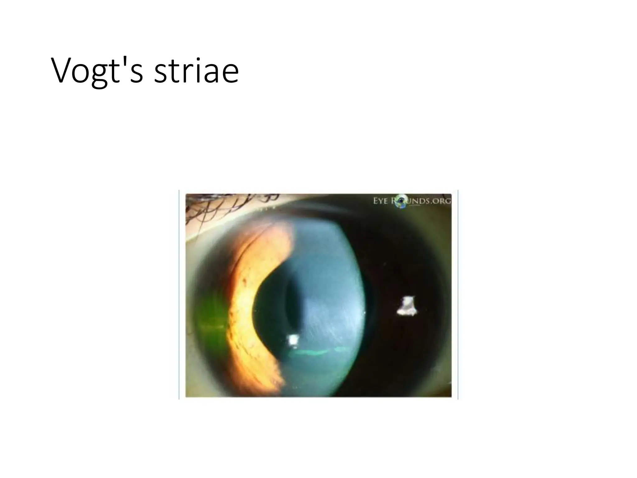 Diseases of cornea keratoconus 222.pptx