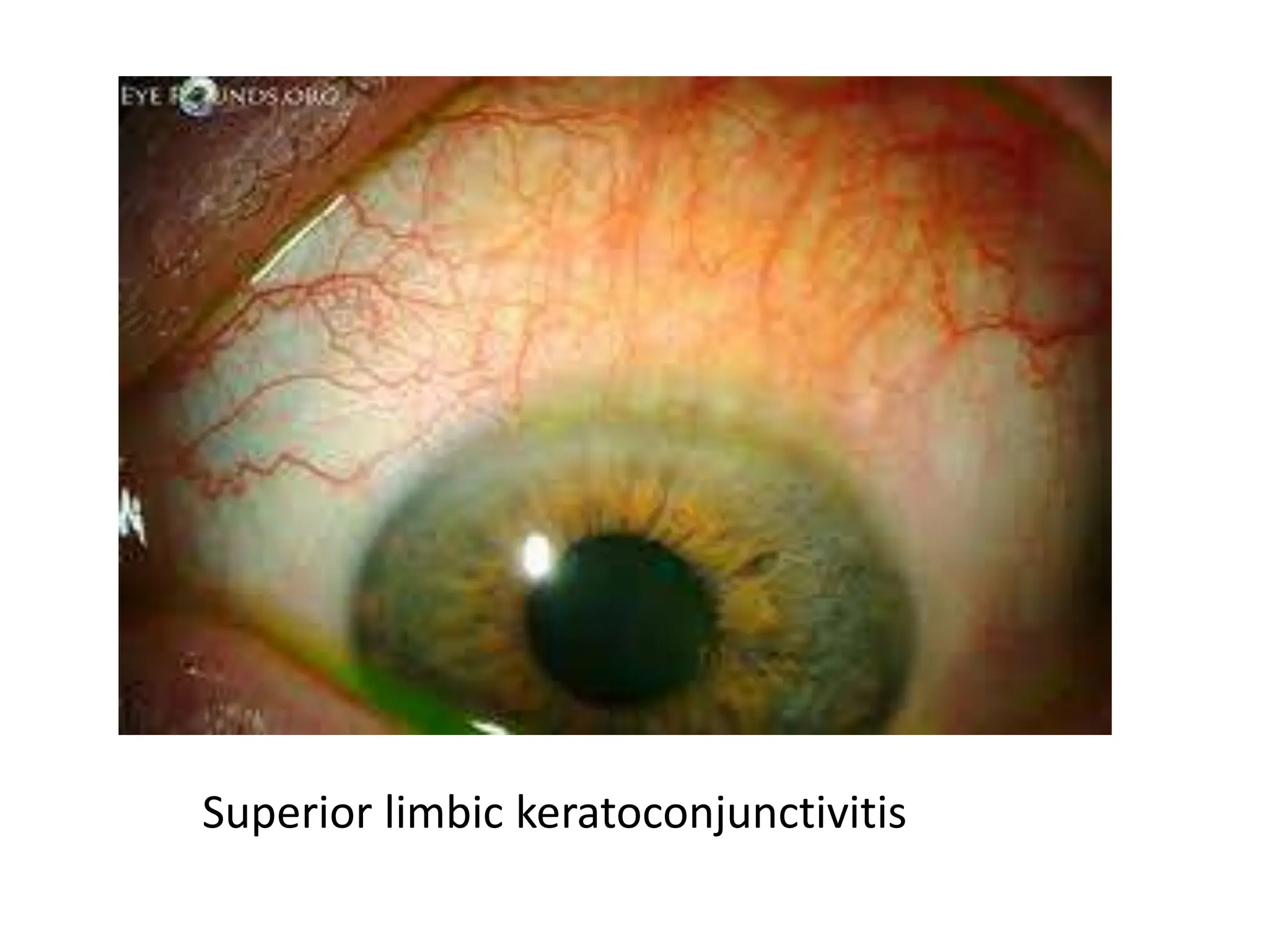 Diseases of cornea keratoconus 222.pptx