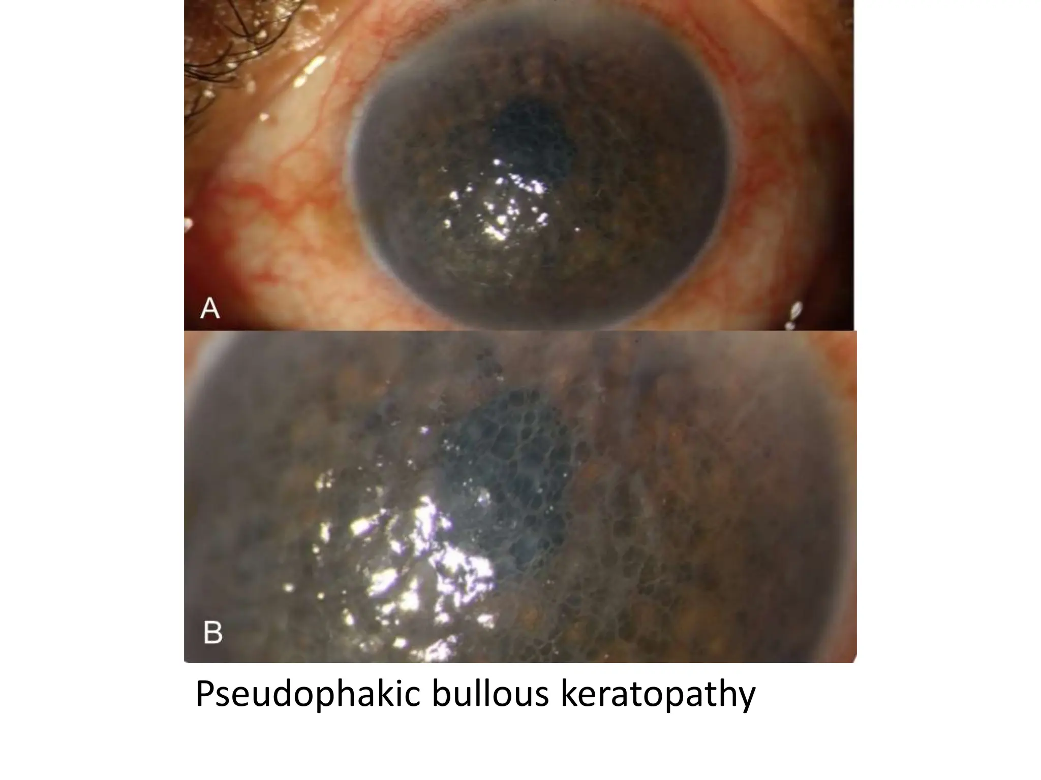 Diseases of cornea keratoconus 222.pptx