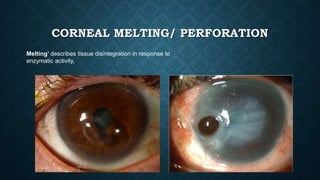 cornea 3 rd year 2023.pptx