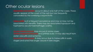 cornea 3 Viral keratitis fourth year MBBS eye lecture | PPTX