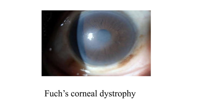 Corneal anatomy and anatomy of limbus ! | PPTX | Eye and Vision ...
