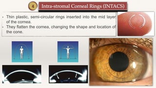 Cornea integrated.pptx