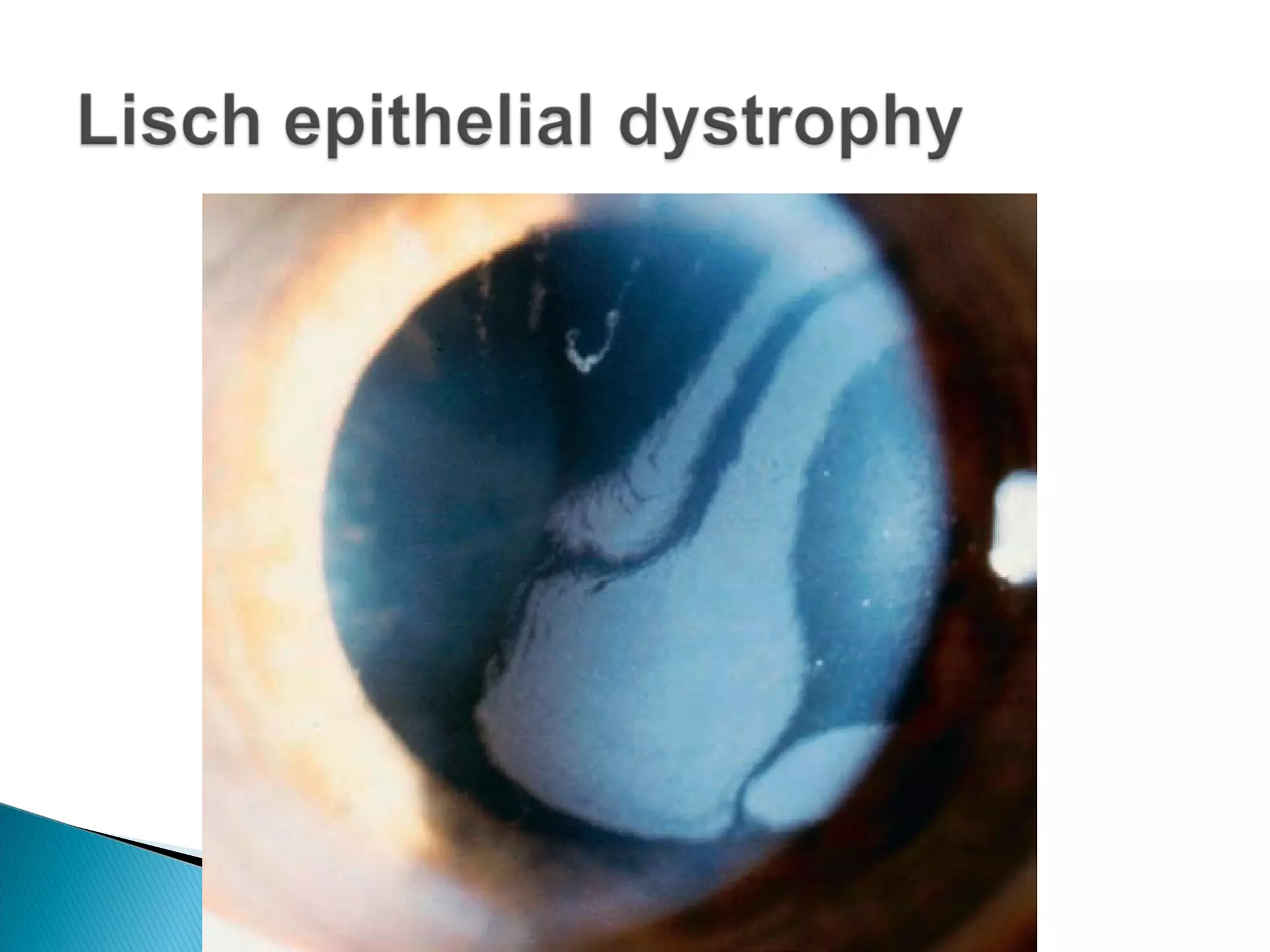 Corneal dystrophies part 1 | PPT | Eye and Vision Conditions | Diseases ...