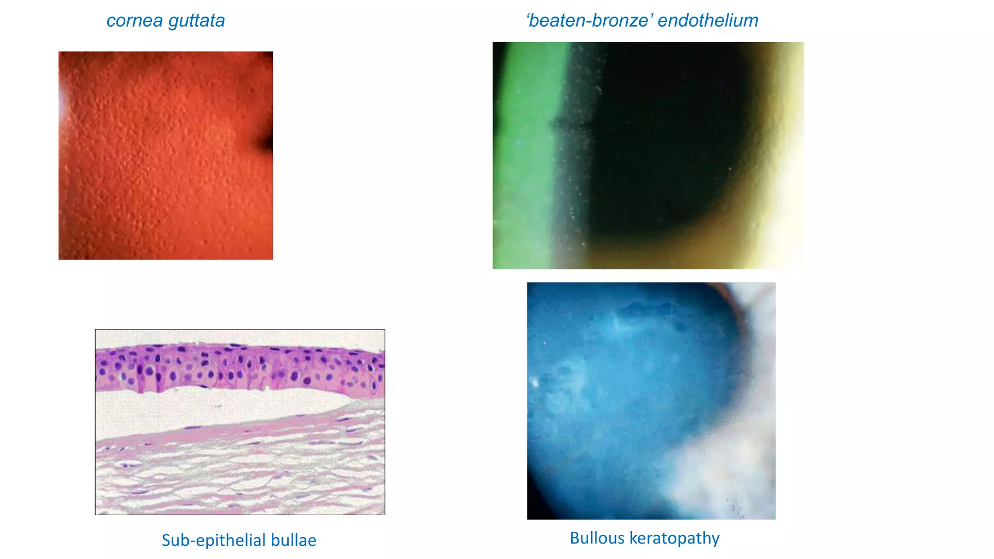 CORNEAL-DYSTROPHIES-Nafiz(2).pptx