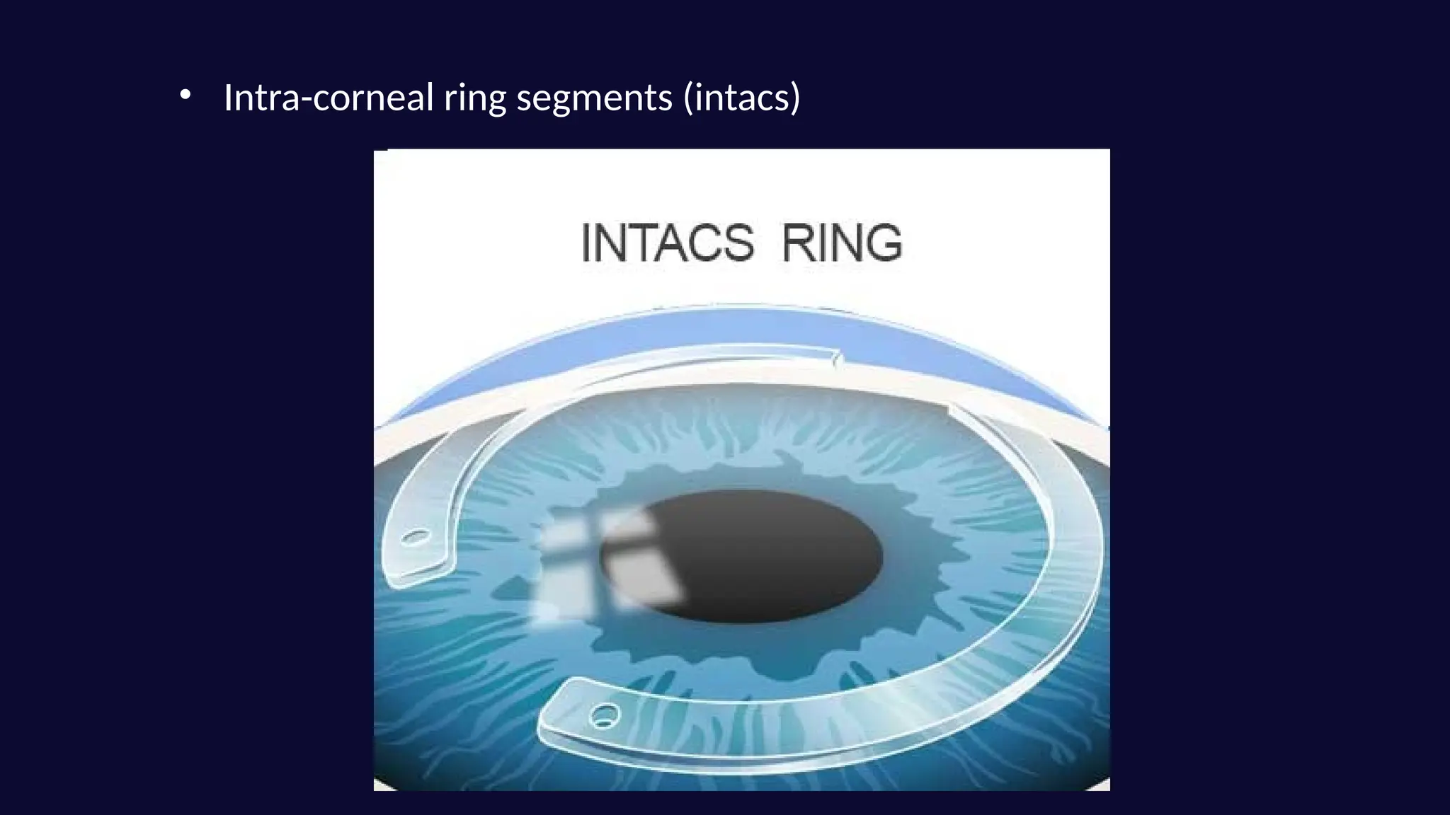 Corneal - Ectasia - presentation 1 .pptx