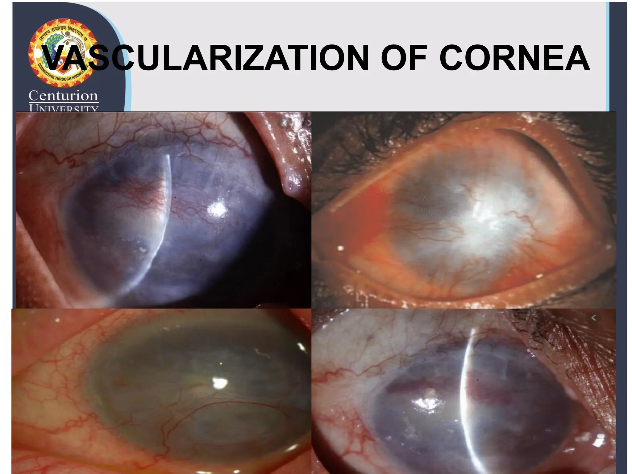Corneal-vascularisation.pdf cornea disease | PDF