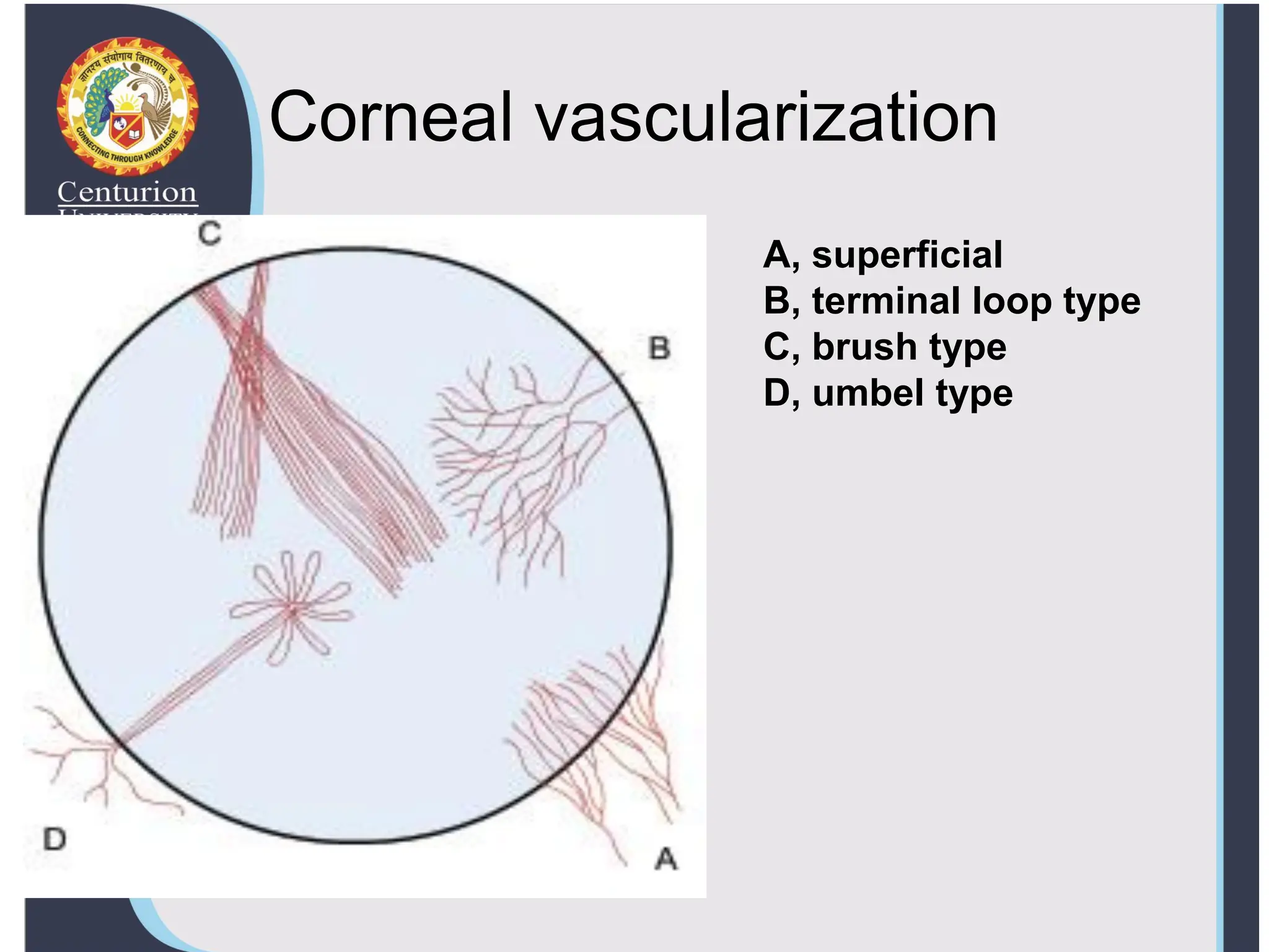 Corneal-vascularisation.pdf cornea disease | PDF