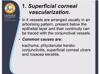 Corneal-vascularisation.pdf cornea disease | PDF