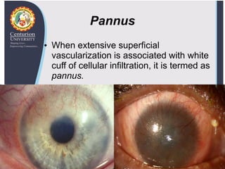 Corneal-vascularisation.pdf cornea disease | PDF