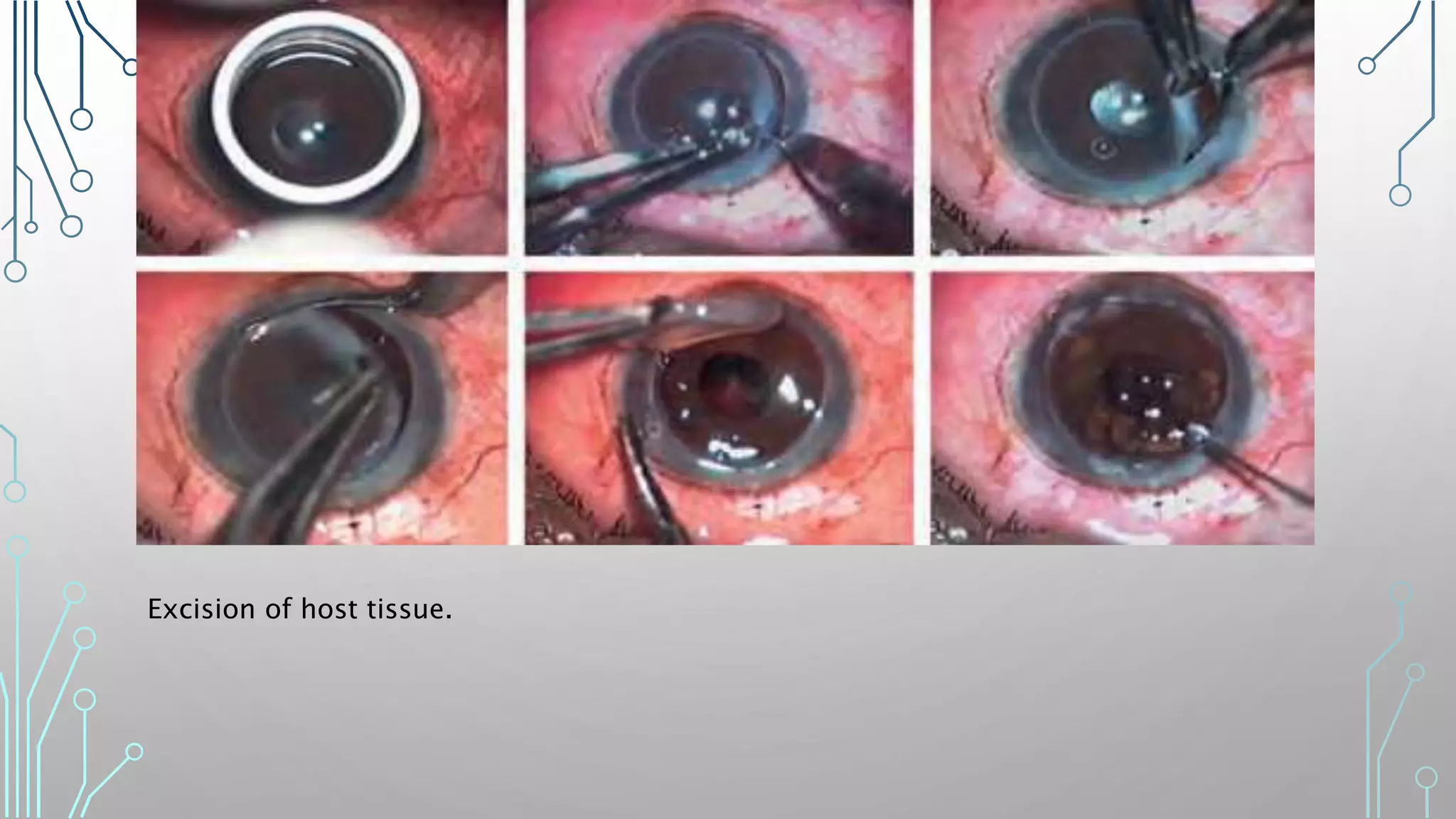 CORNEAL AND REFRACTIVE SURGERY | PPTX