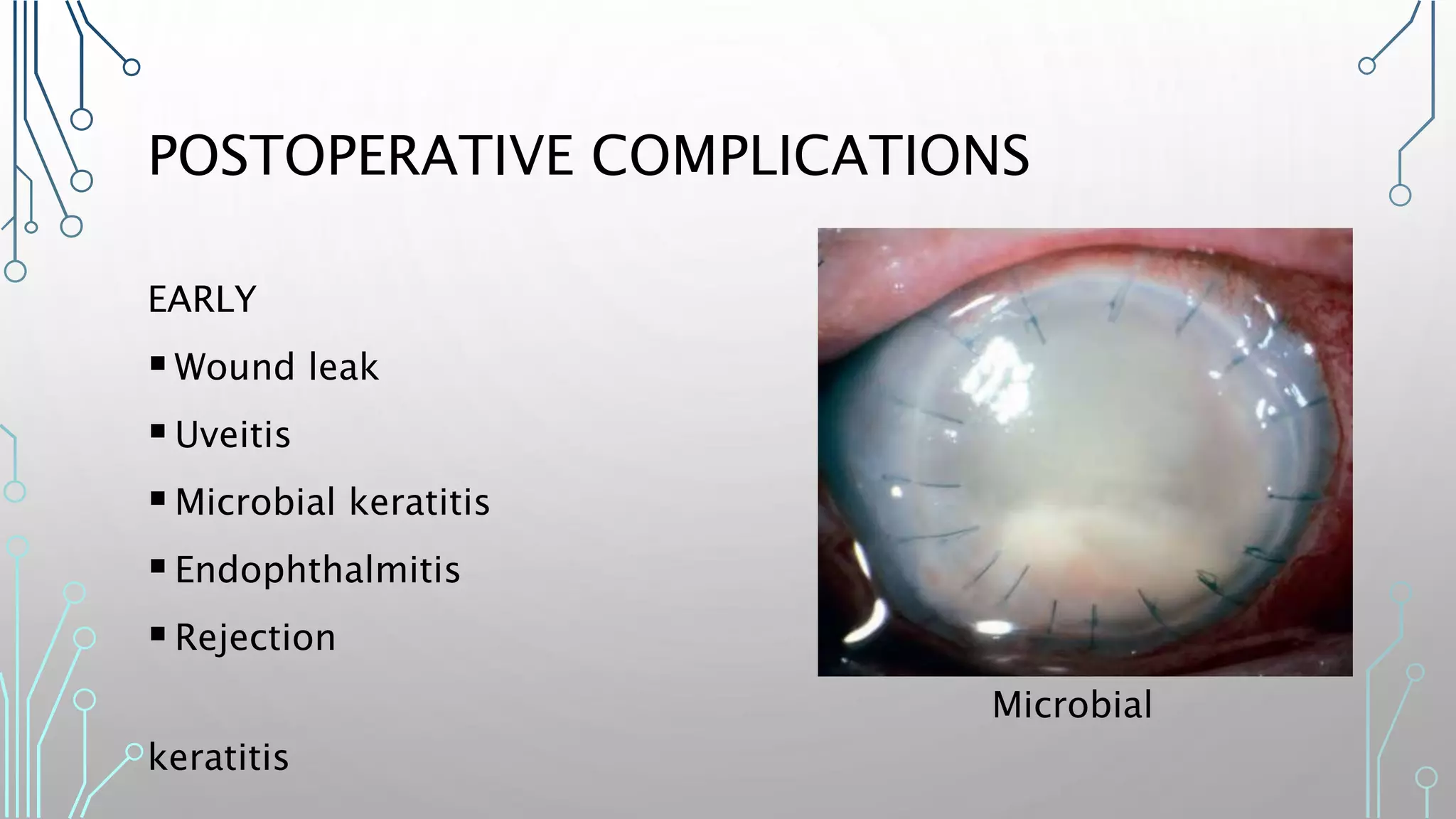 CORNEAL AND REFRACTIVE SURGERY | PPTX