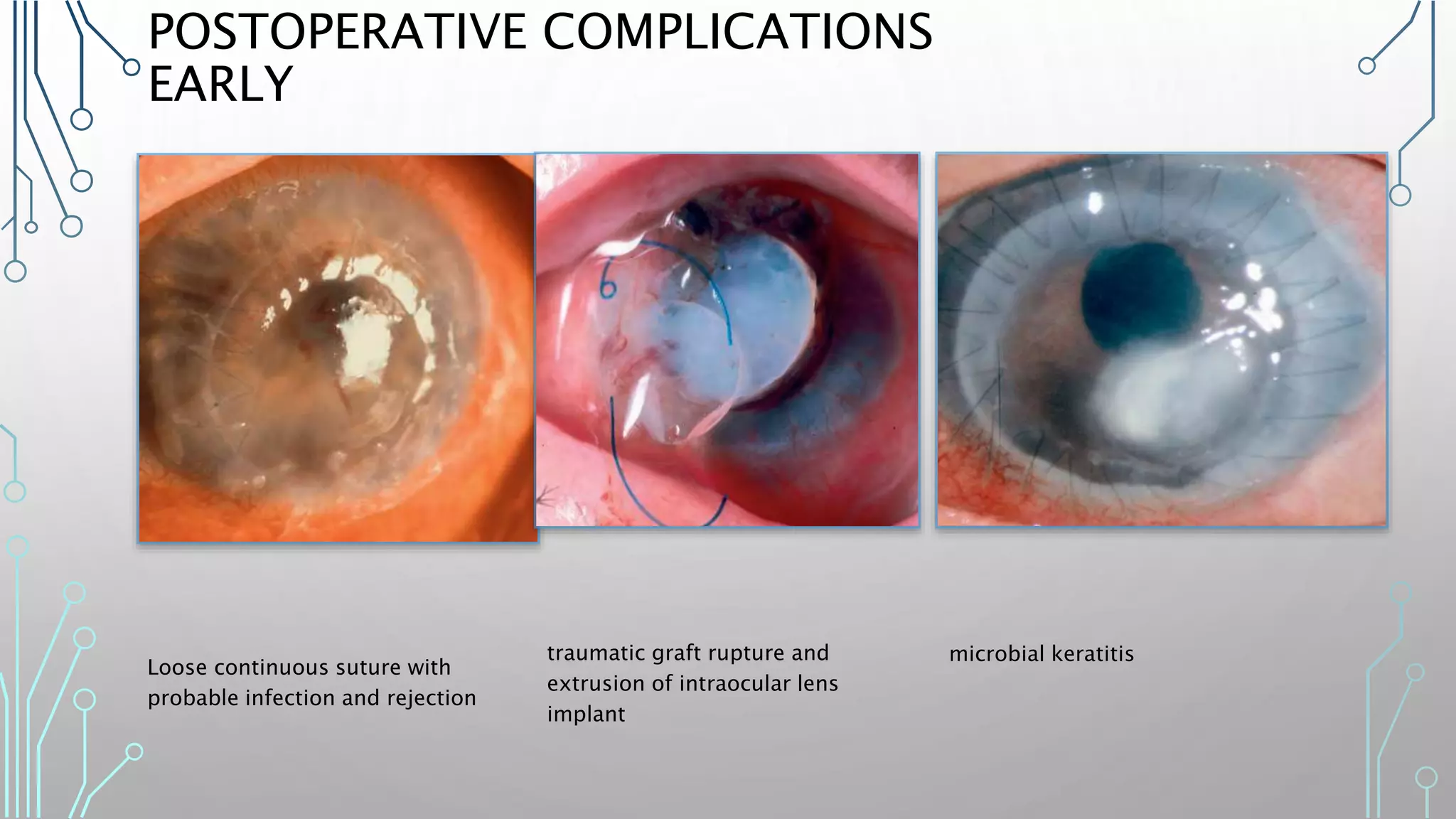 CORNEAL AND REFRACTIVE SURGERY | PPTX