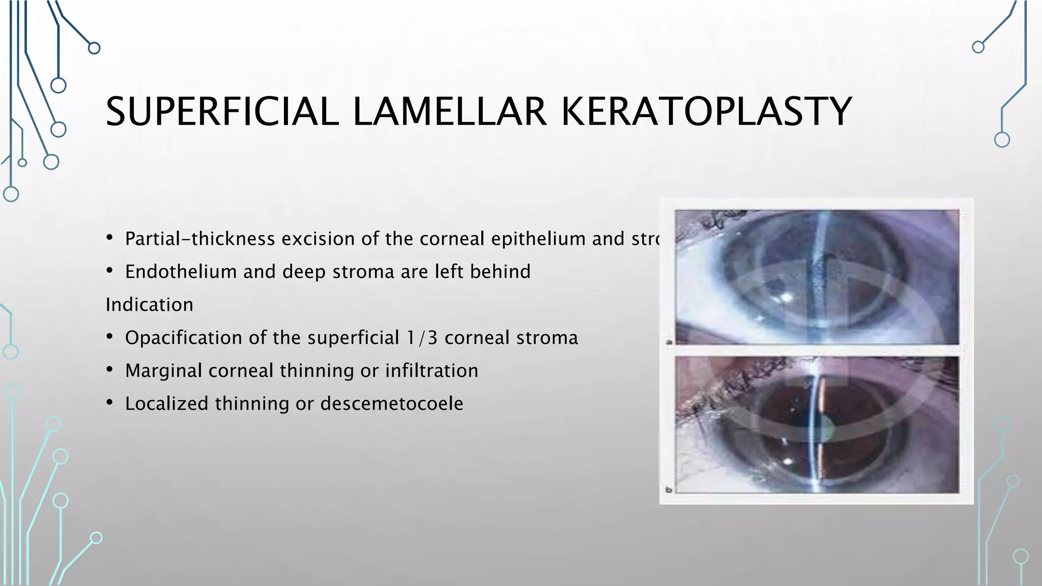 CORNEAL AND REFRACTIVE SURGERY | PPTX