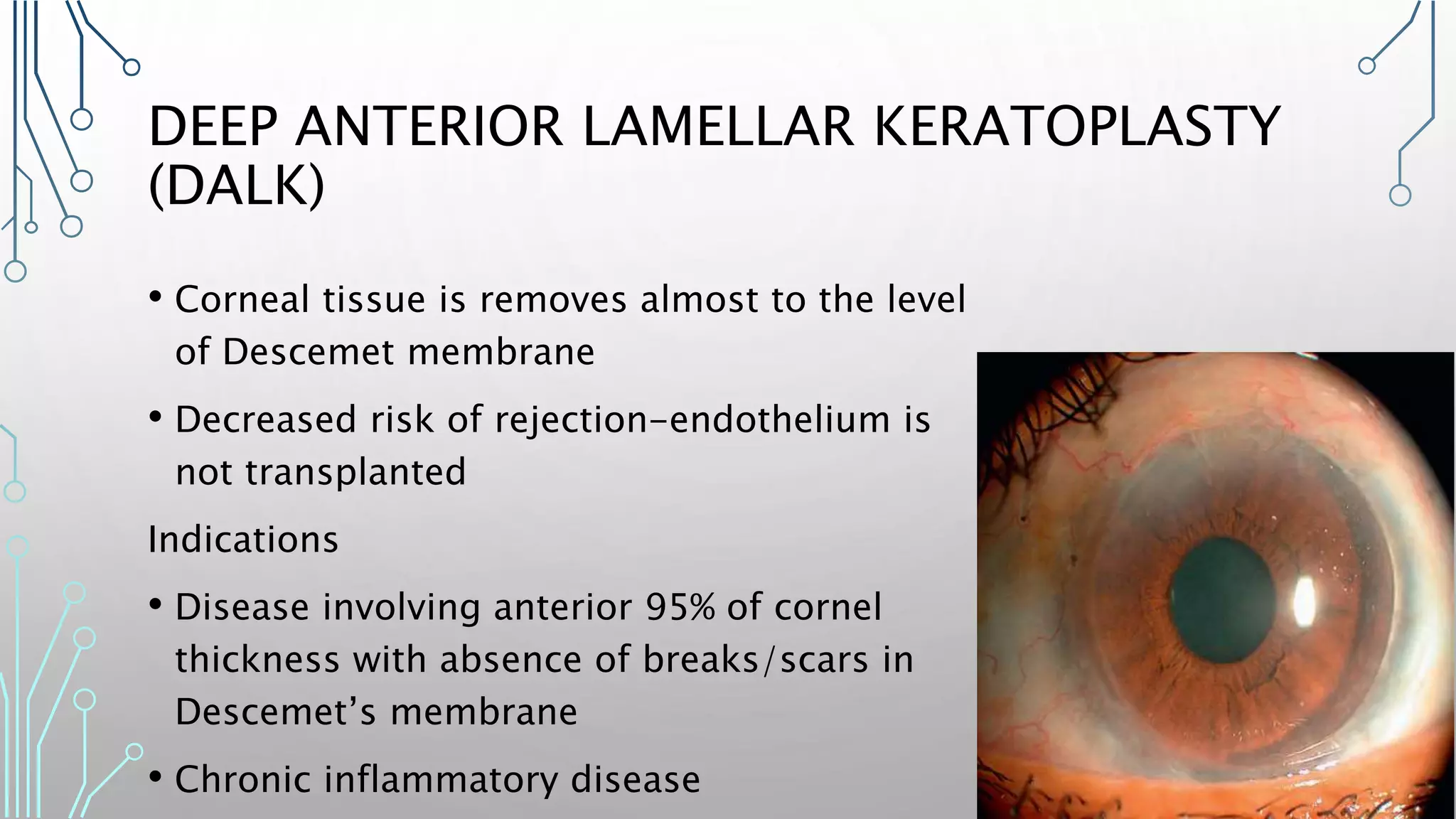 CORNEAL AND REFRACTIVE SURGERY | PPTX
