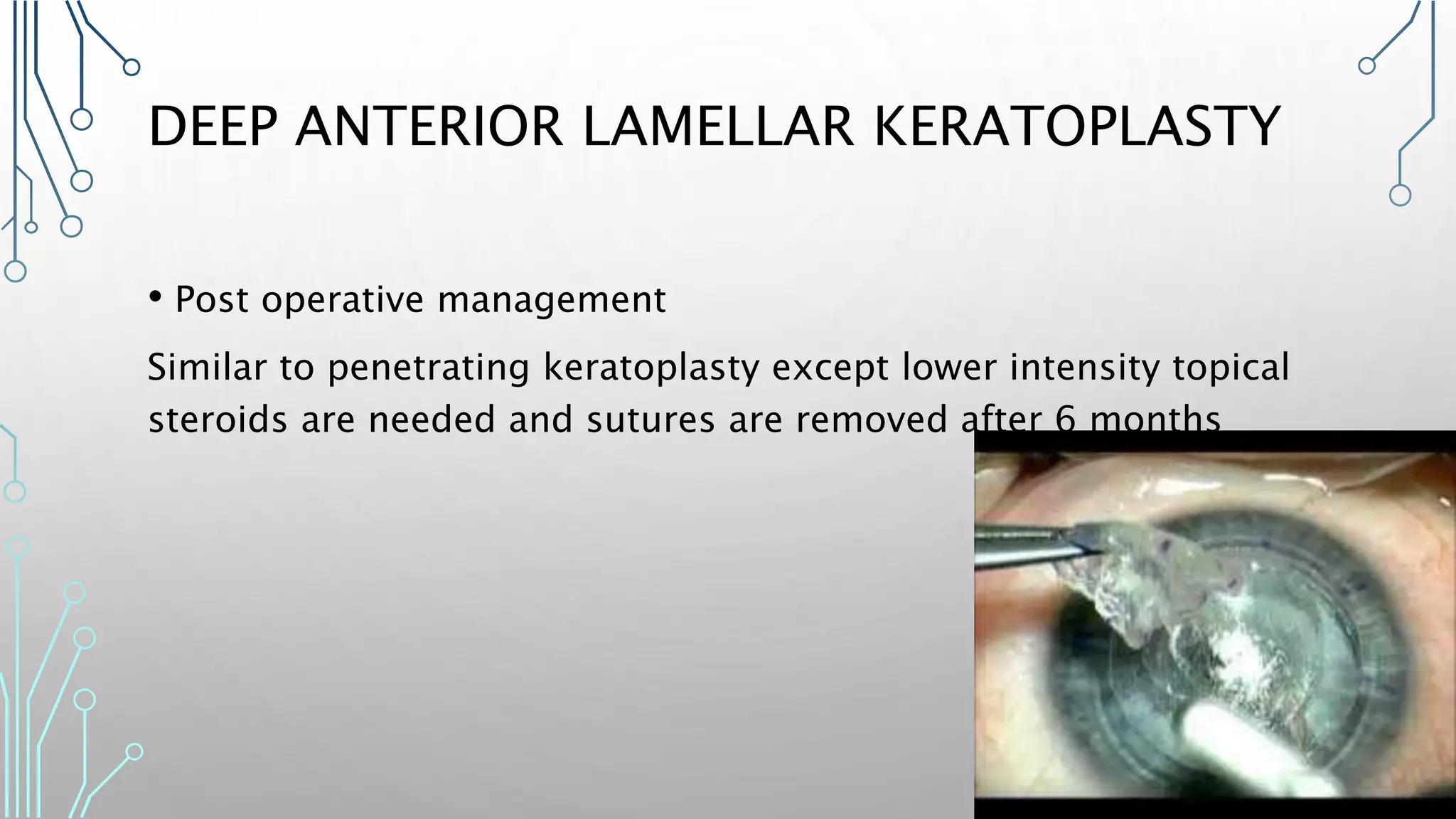 CORNEAL AND REFRACTIVE SURGERY | PPTX