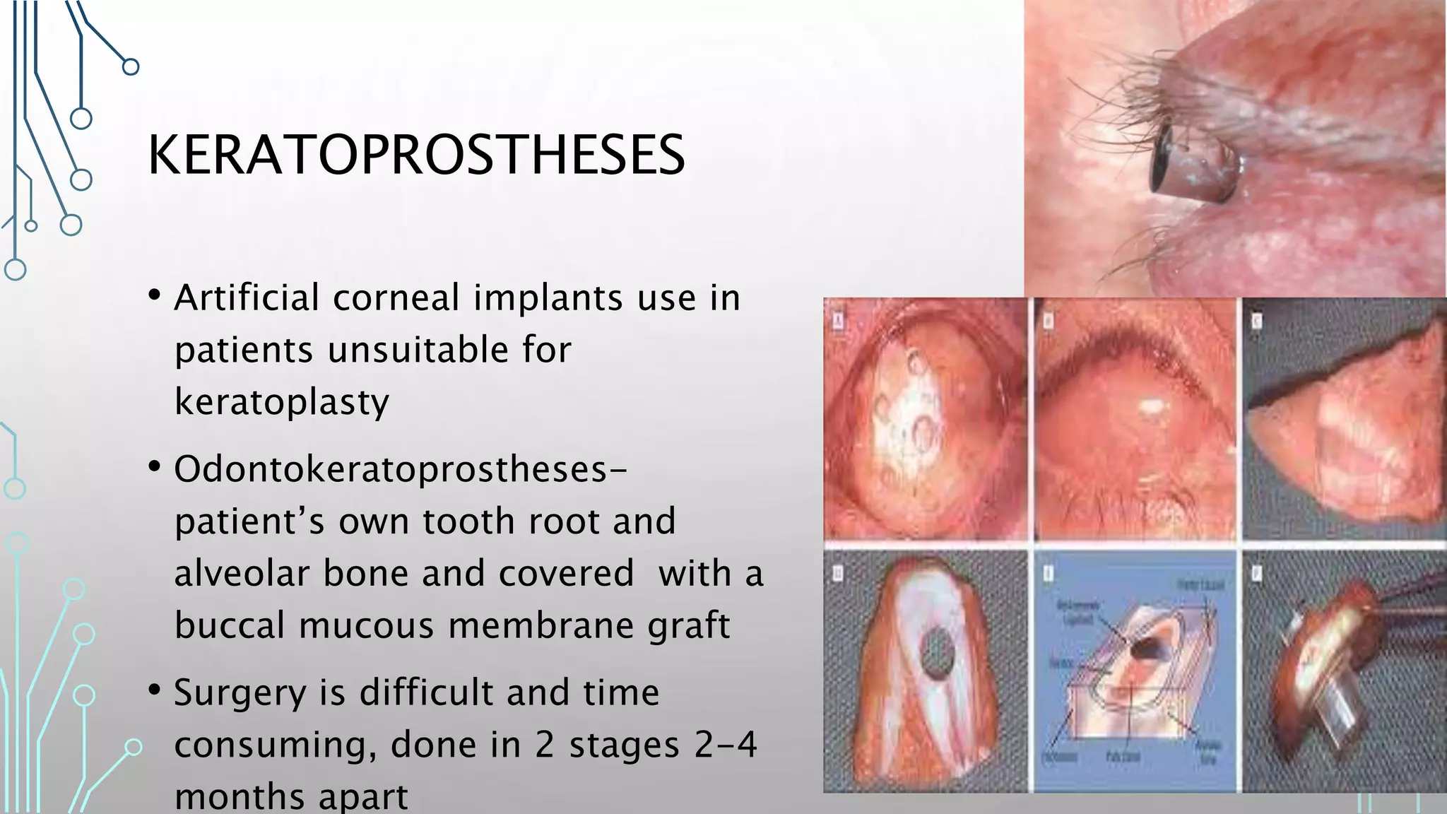 CORNEAL AND REFRACTIVE SURGERY | PPTX