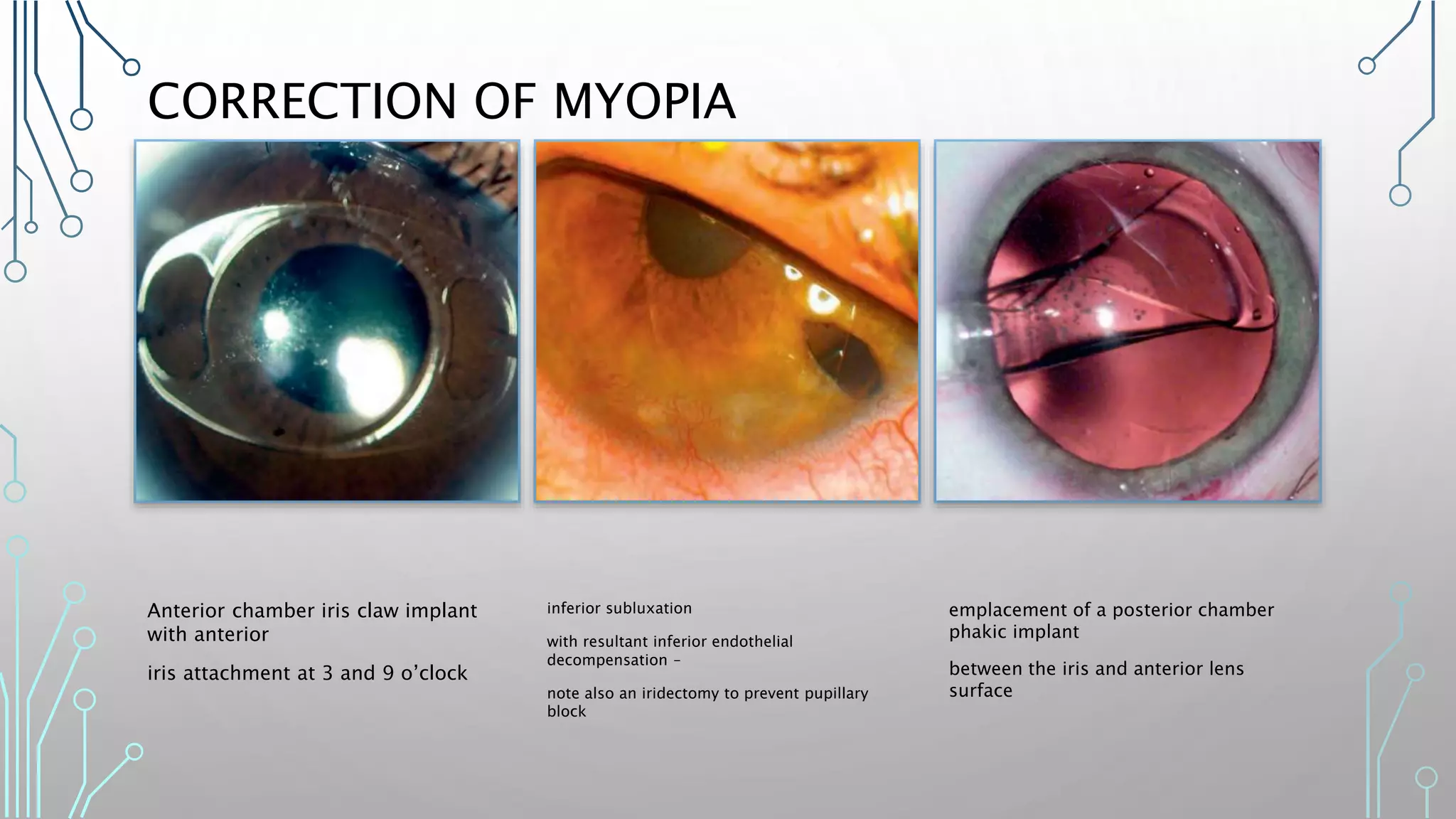 CORNEAL AND REFRACTIVE SURGERY | PPTX