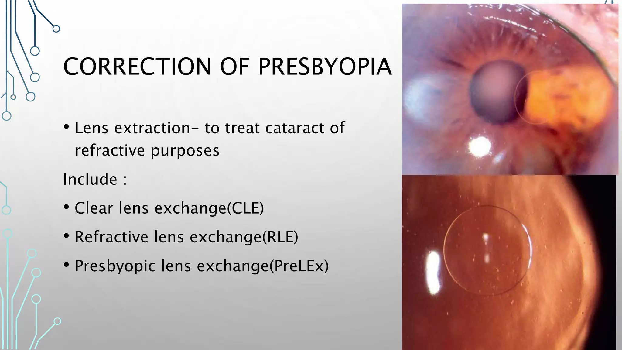 CORNEAL AND REFRACTIVE SURGERY | PPTX