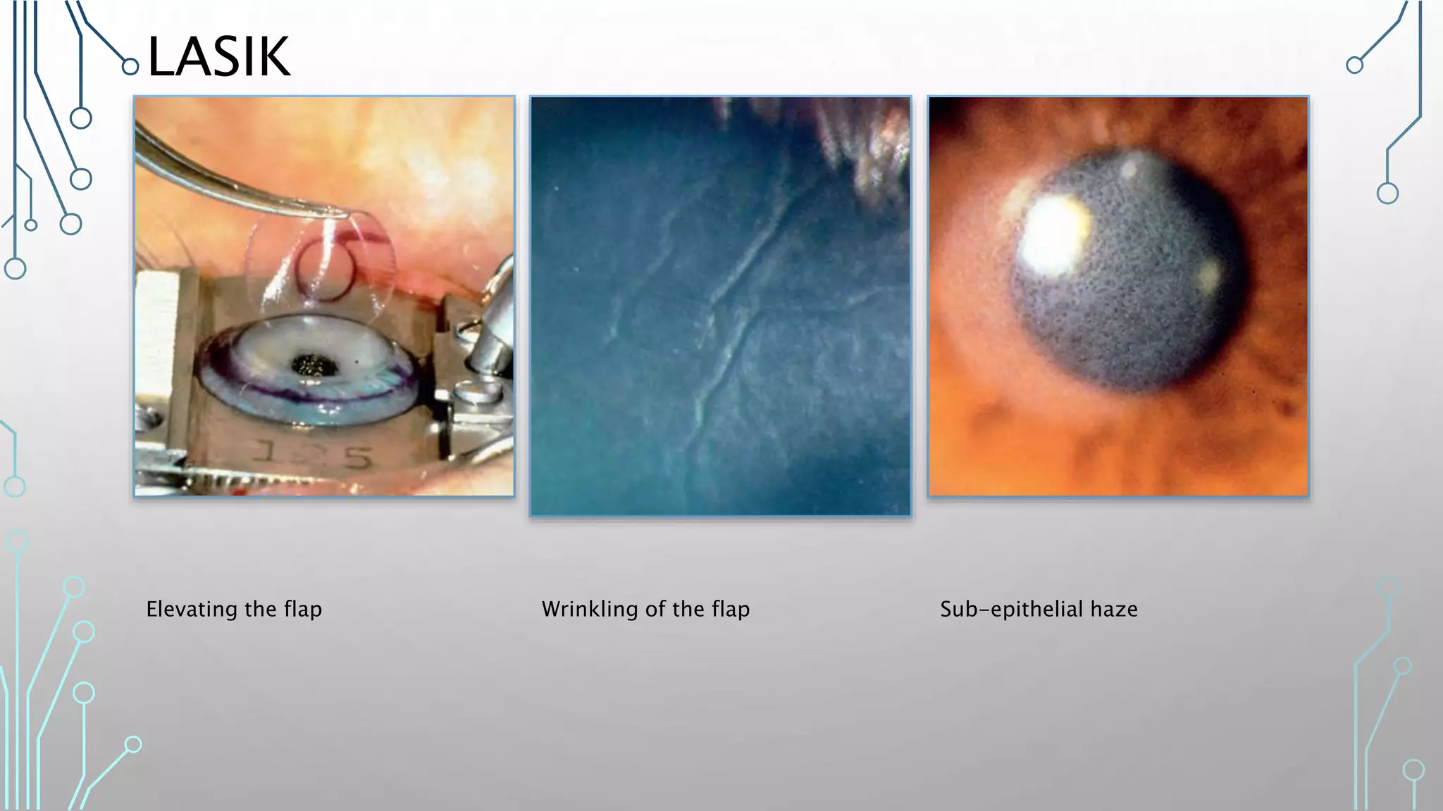 CORNEAL AND REFRACTIVE SURGERY | PPTX