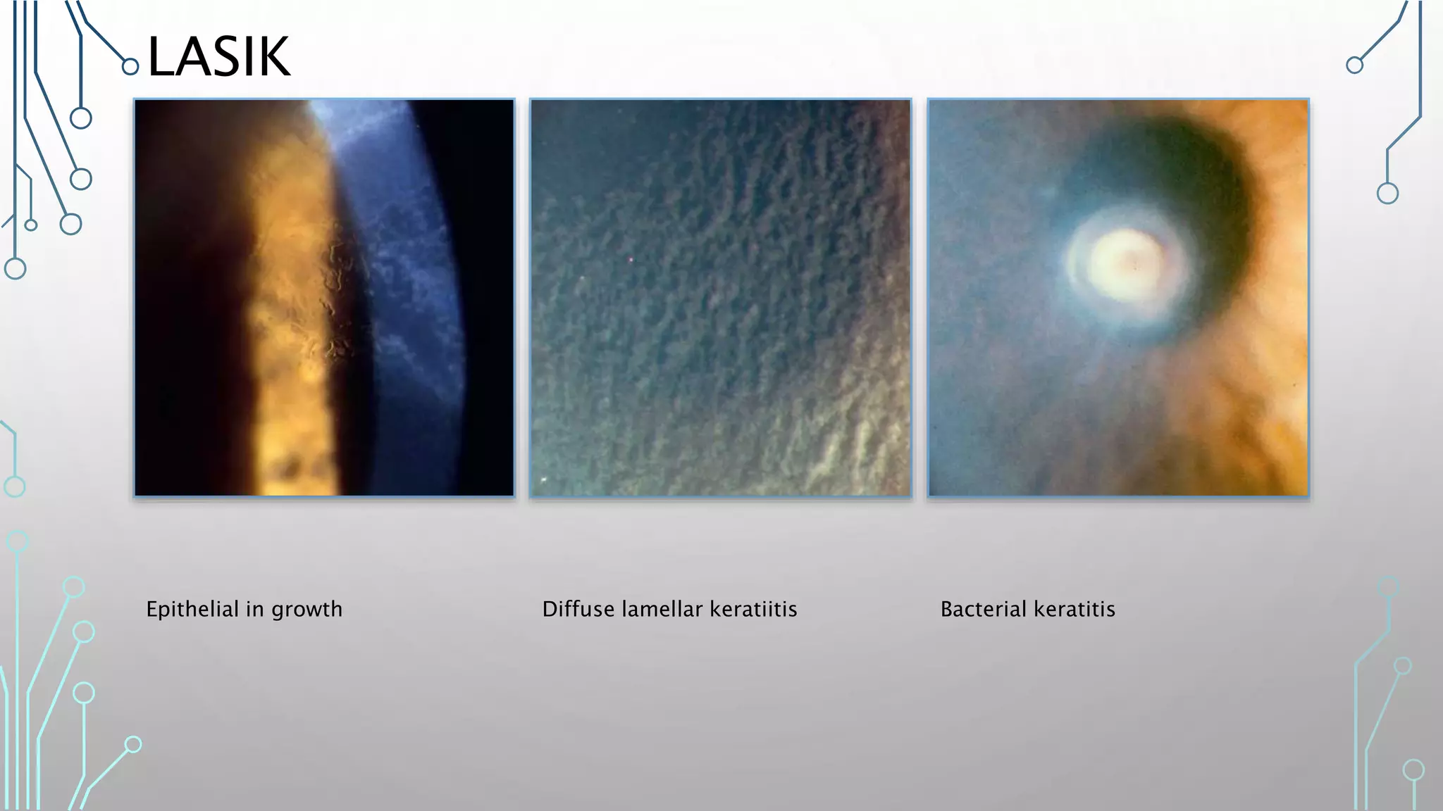 CORNEAL AND REFRACTIVE SURGERY | PPTX