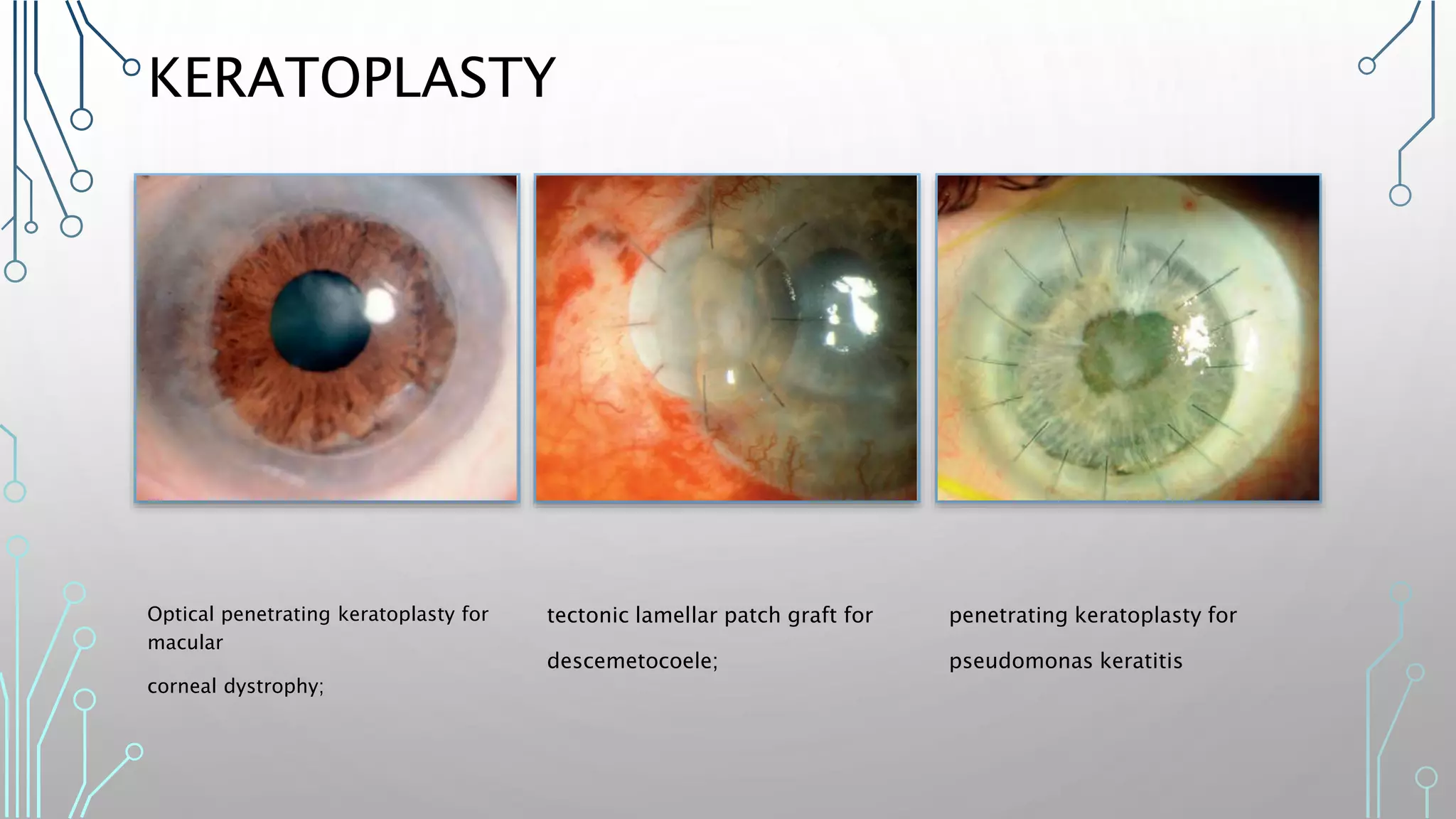 CORNEAL AND REFRACTIVE SURGERY | PPTX