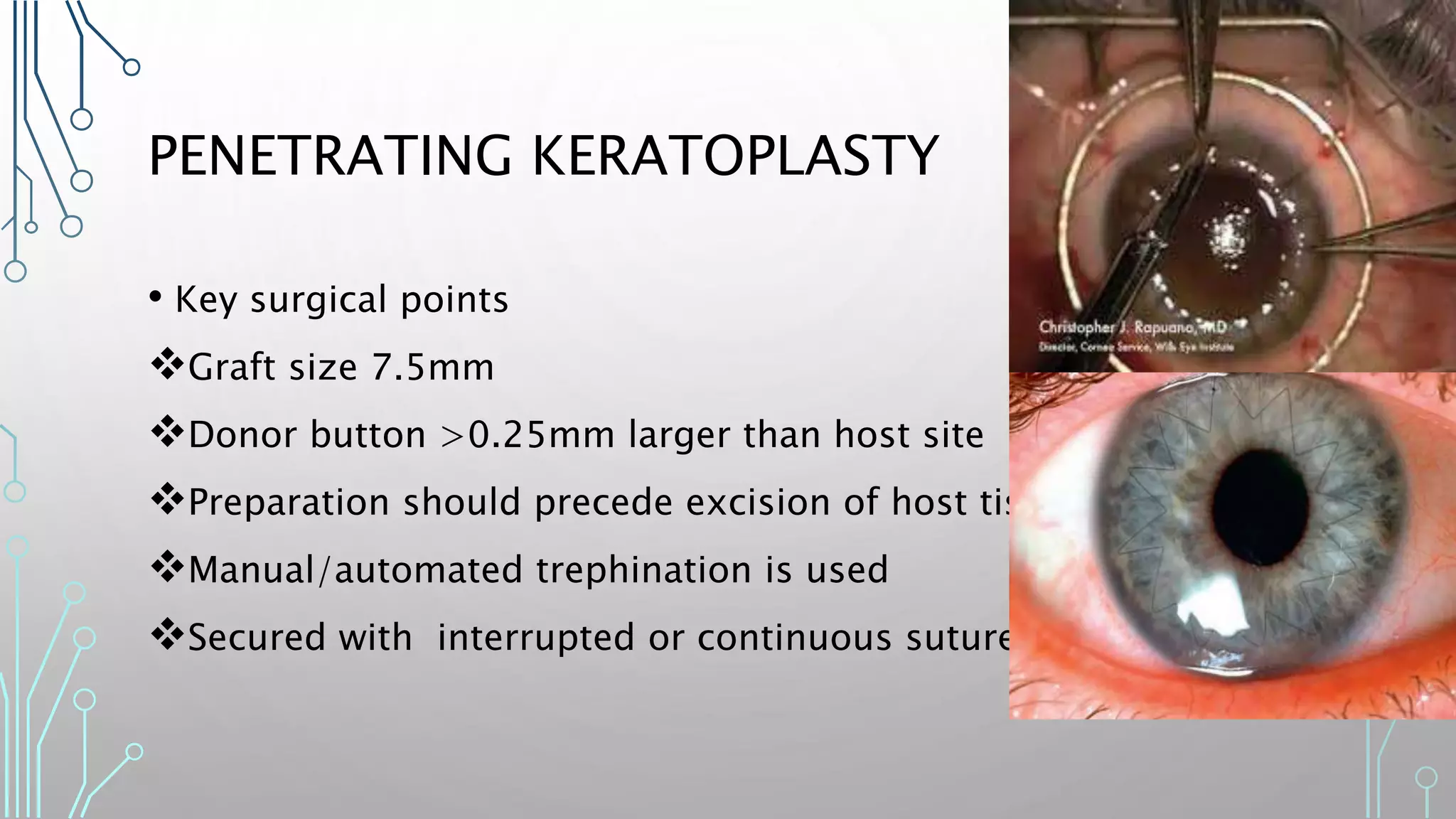 CORNEAL AND REFRACTIVE SURGERY | PPTX