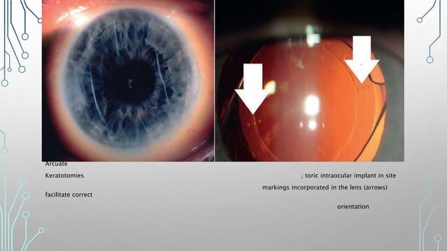 CORNEAL AND REFRACTIVE SURGERY | PPTX