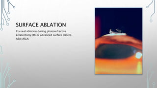 CORNEAL AND REFRACTIVE SURGERY | PPTX