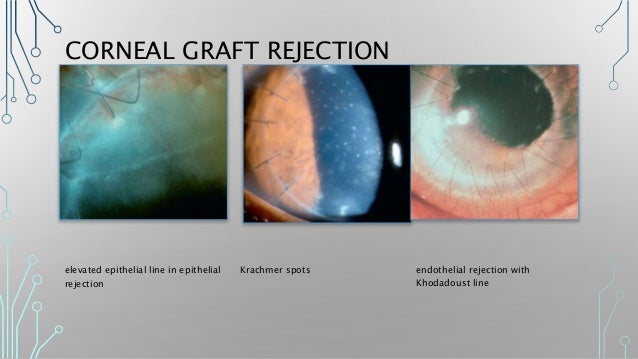 CORNEAL AND REFRACTIVE SURGERY