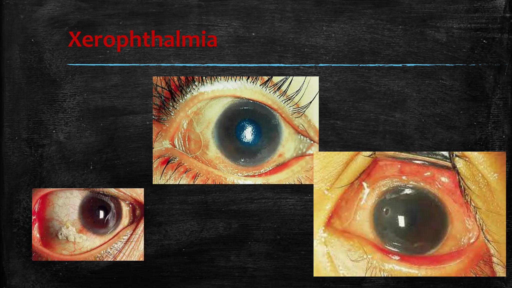 Corneal Causes of Decreased Vision.pptx