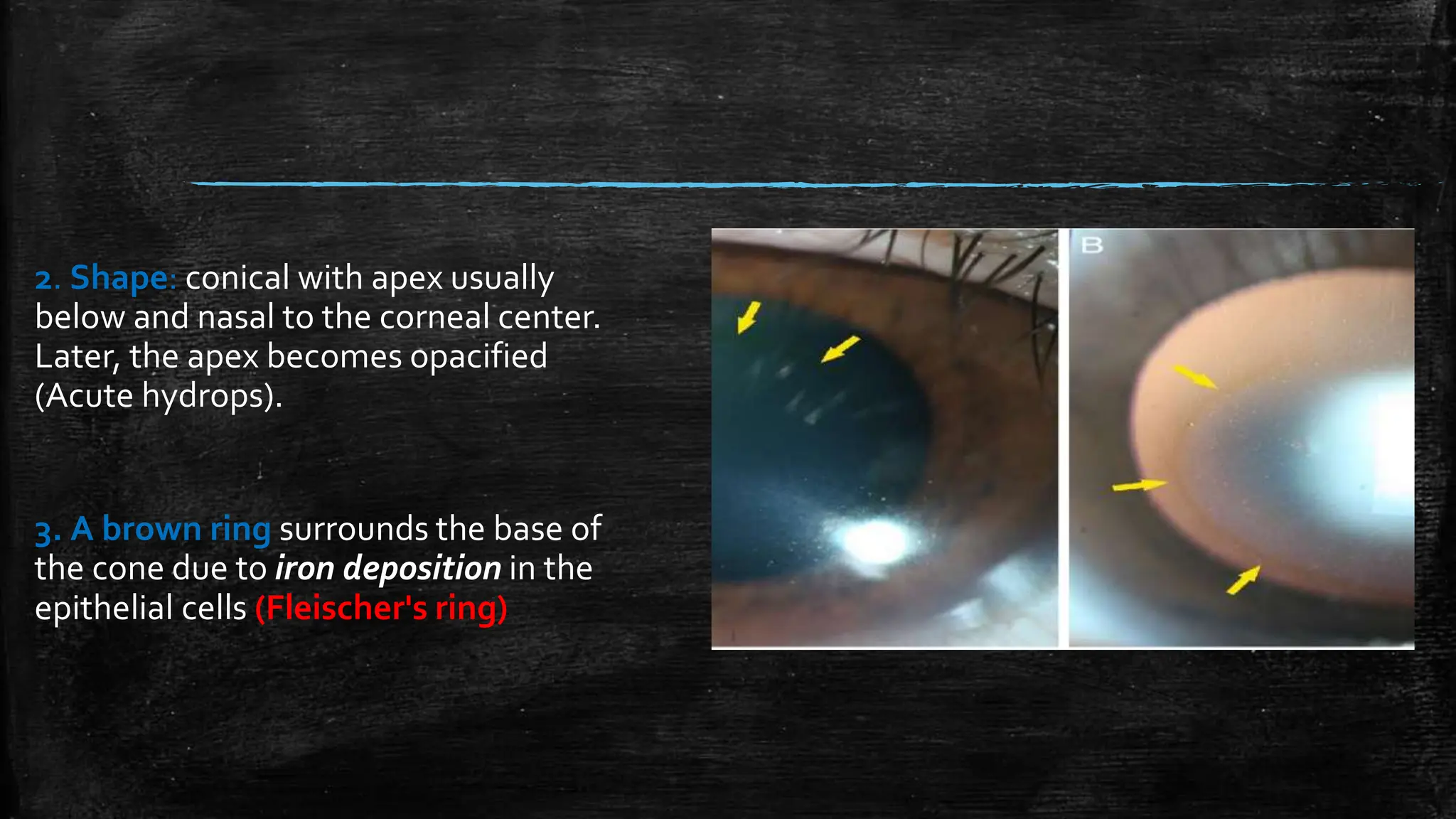 Corneal Causes of Decreased Vision.pptx